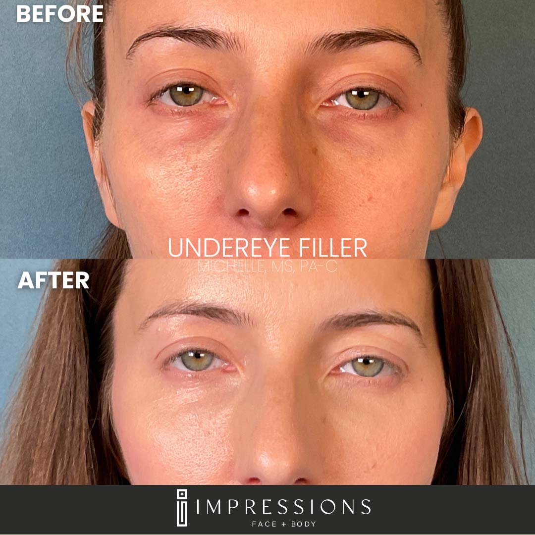Dermal Fillers in Chicago | Impressions Face + Body