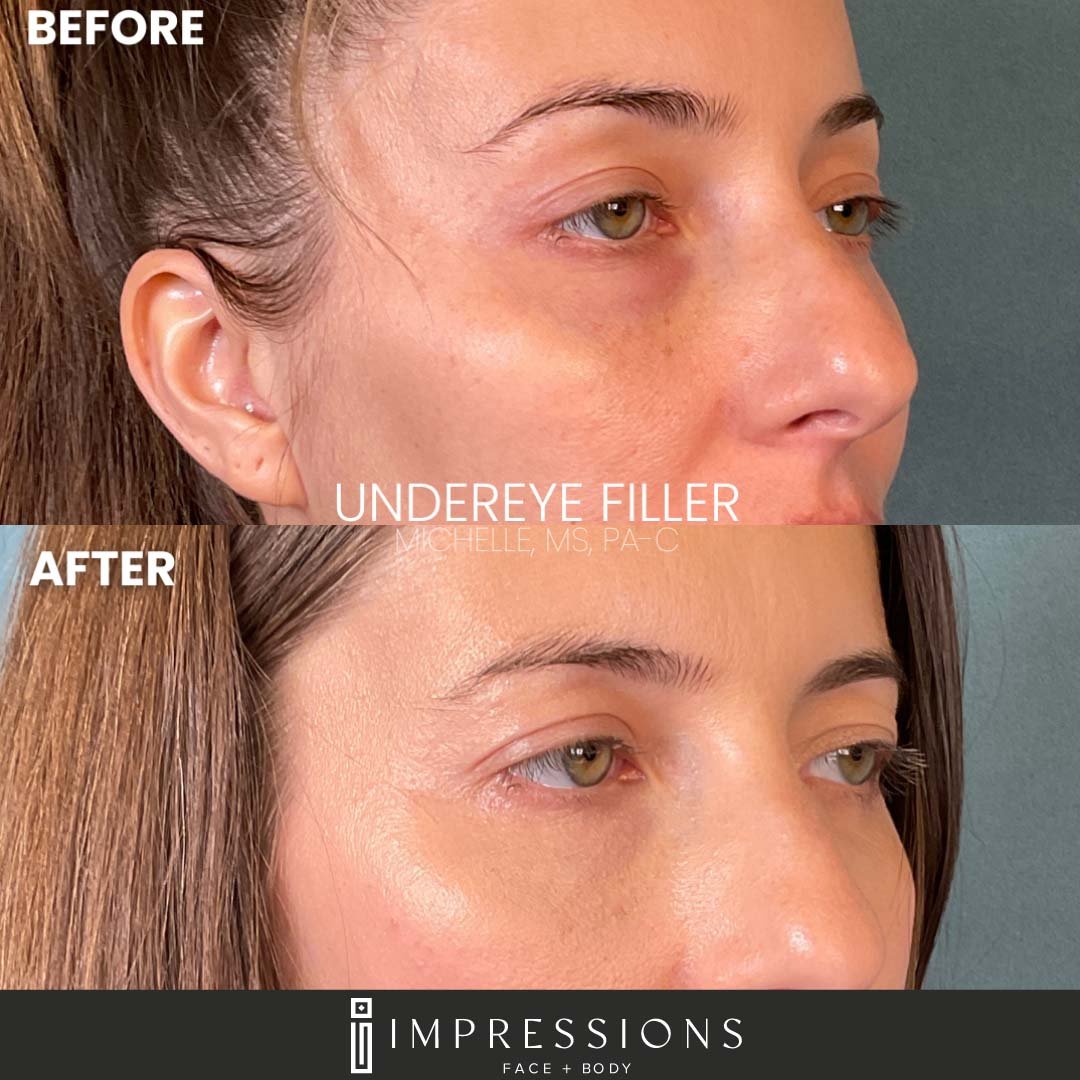 Dermal Fillers in Chicago | Impressions Face + Body
