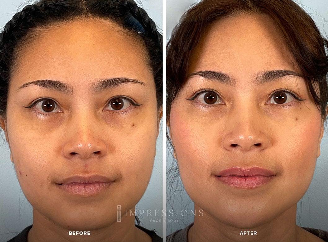 Buccal Fat Removal in Chicago | Impressions Face + Body