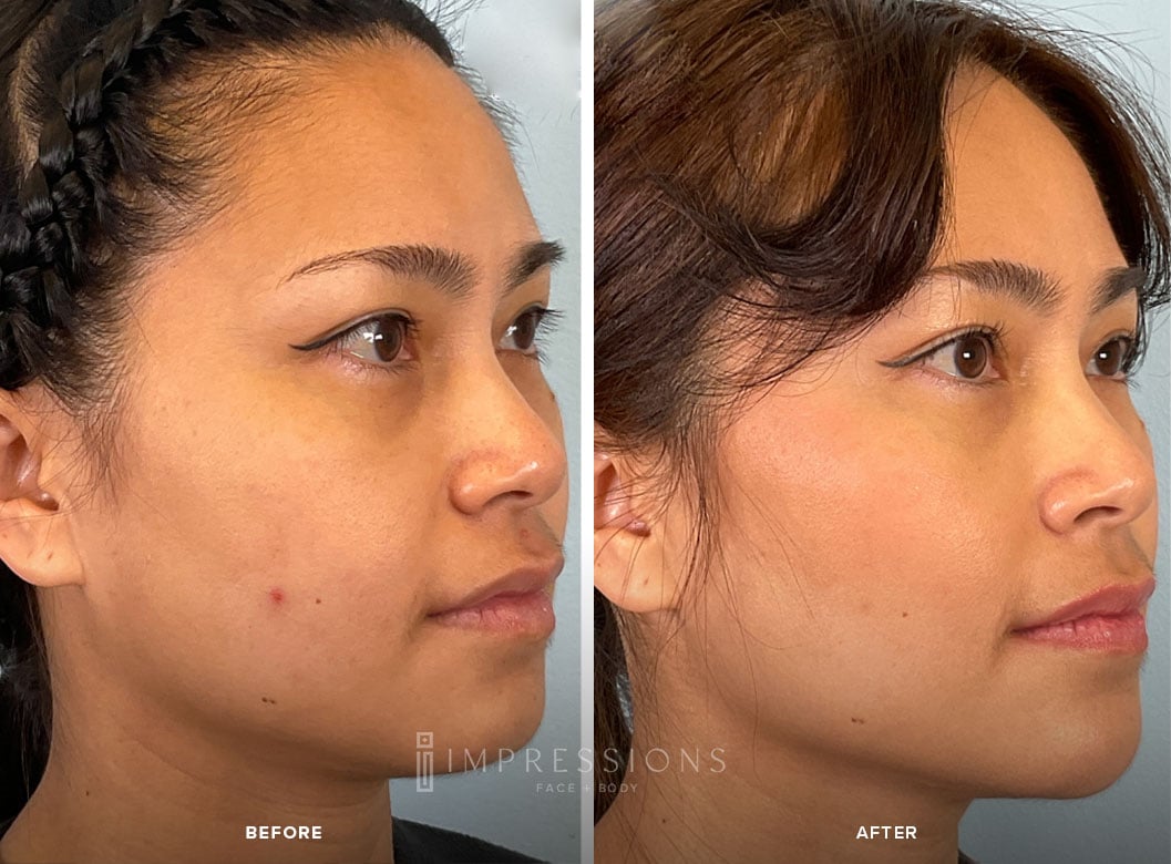 Buccal Fat Removal in Chicago | Impressions Face + Body