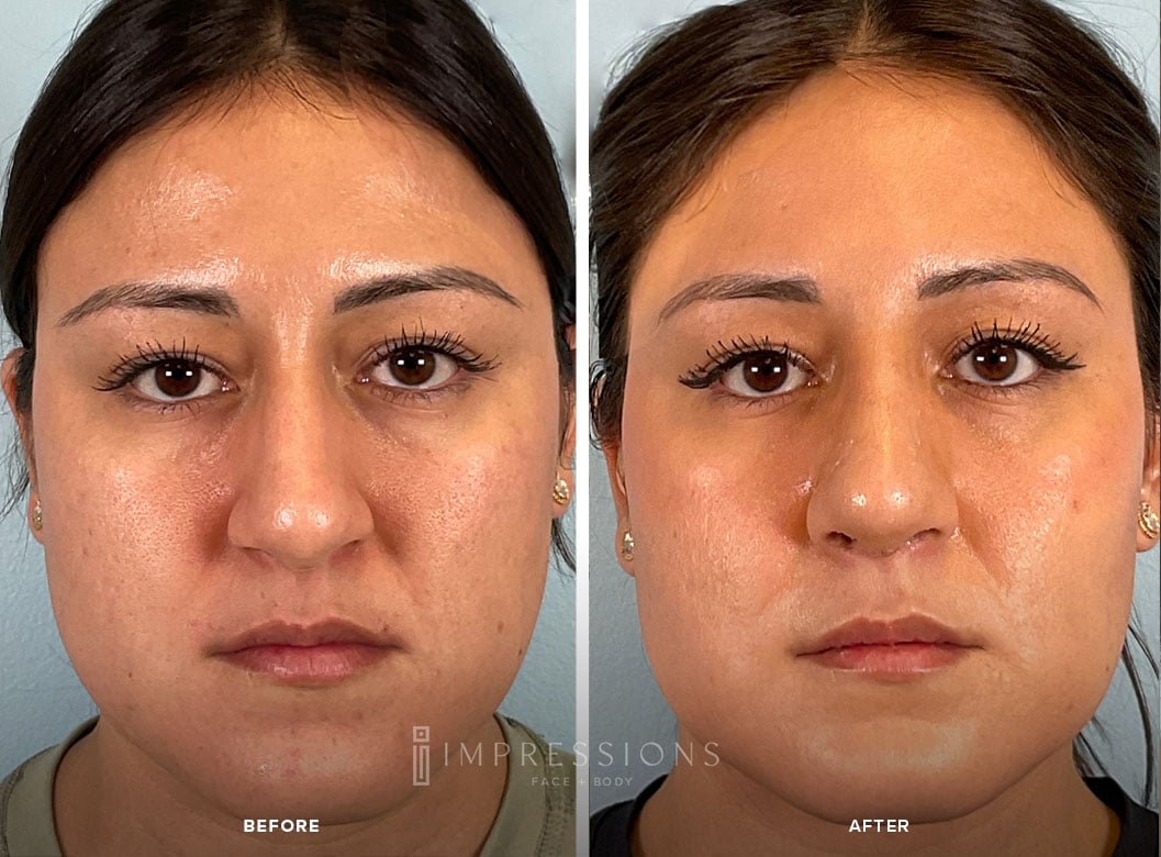 Buccal Fat Removal in Chicago | Impressions Face + Body