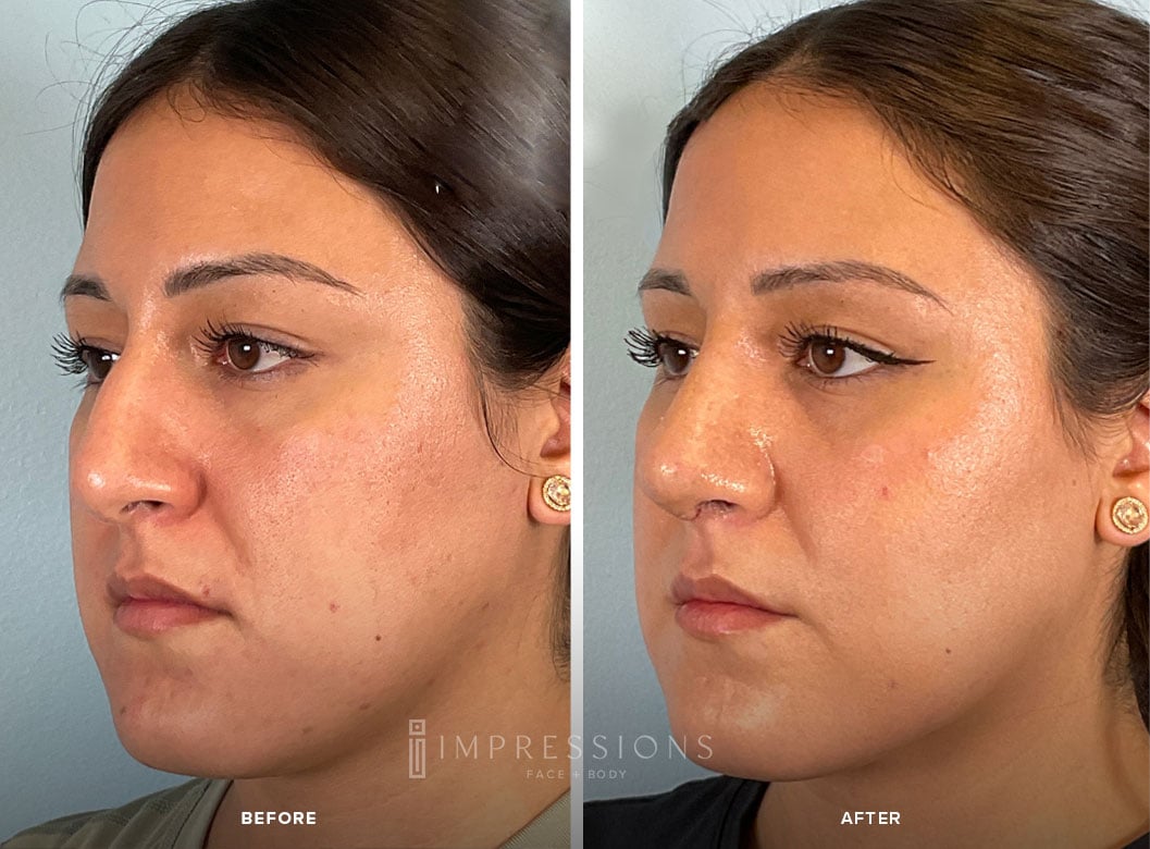 Buccal Fat Removal in Chicago | Impressions Face + Body