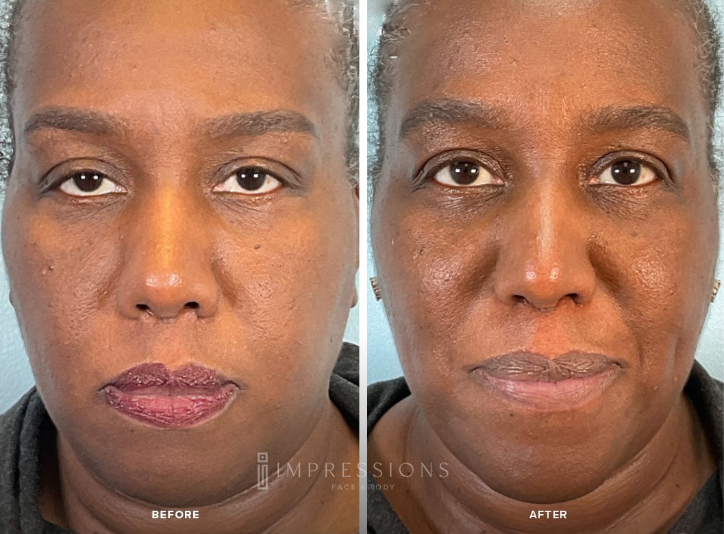 The Face BBL™ in Chicago | Impressions Face + Body