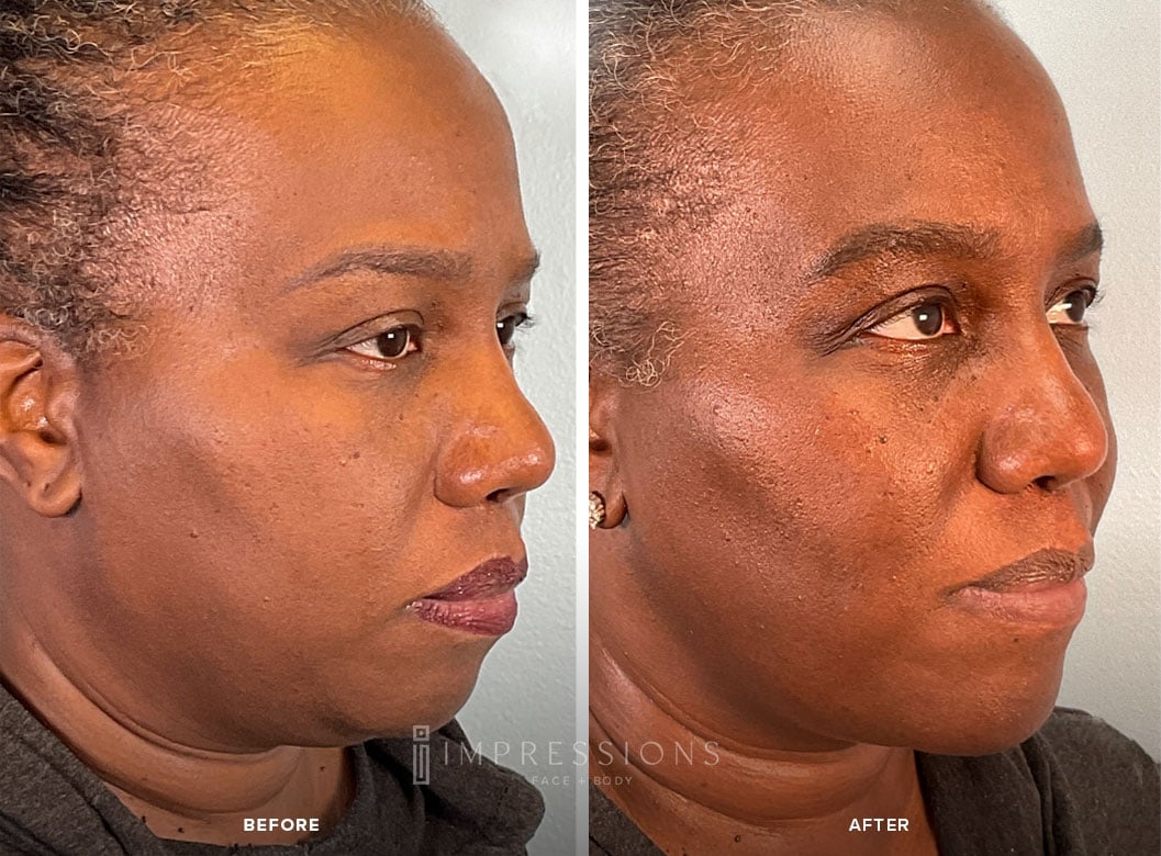 The Face BBL™ in Chicago | Impressions Face + Body