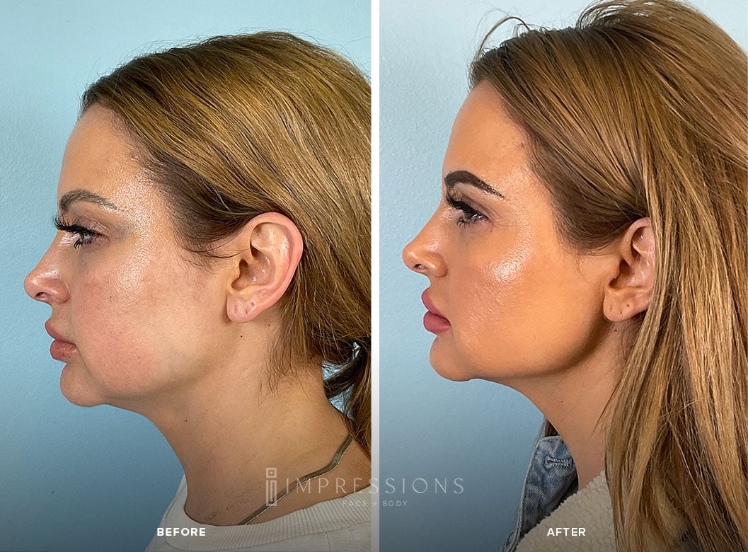 Jawline Filler in Chicago | Impressions Face + Body