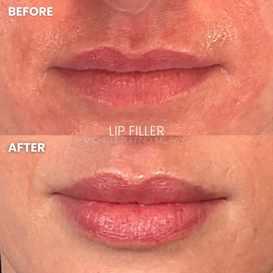 Lip Fillers in Chicago | Impressions Face + Body