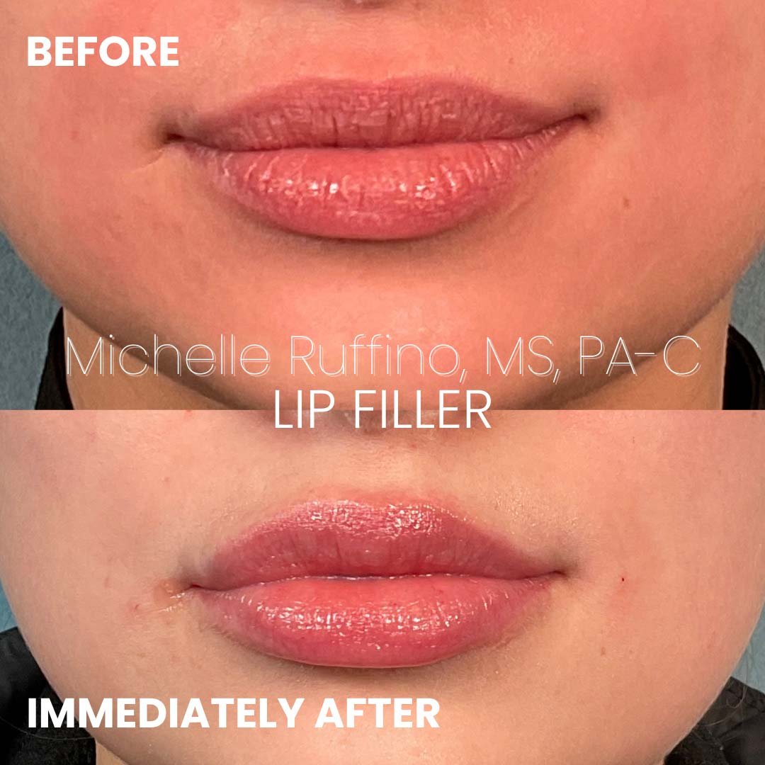 Lip Fillers in Chicago | Impressions Face + Body