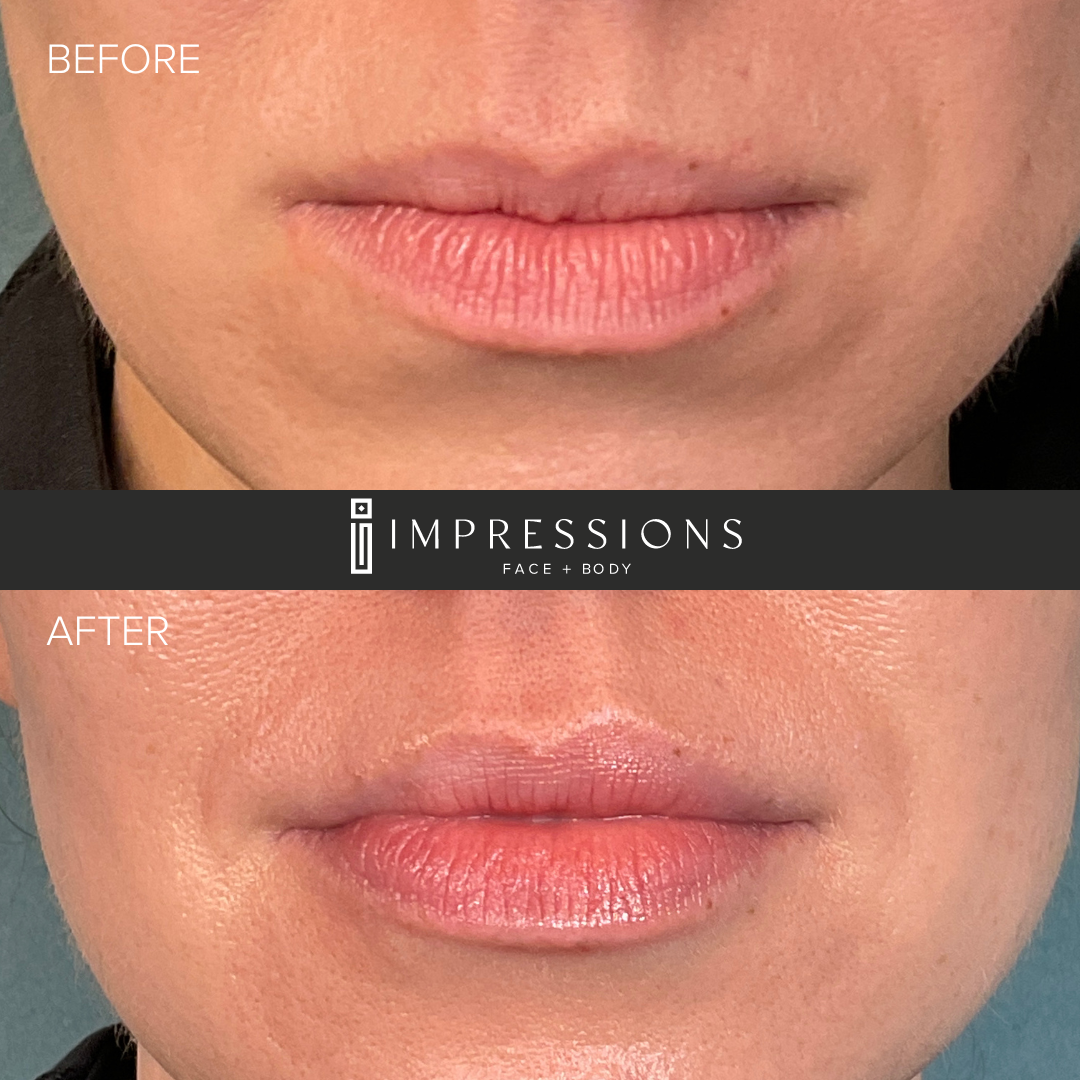 Lip Fillers in Chicago | Impressions Face + Body