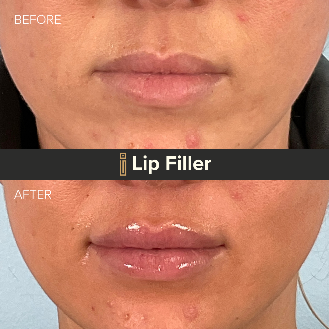 Lip Fillers in Chicago | Impressions Face + Body
