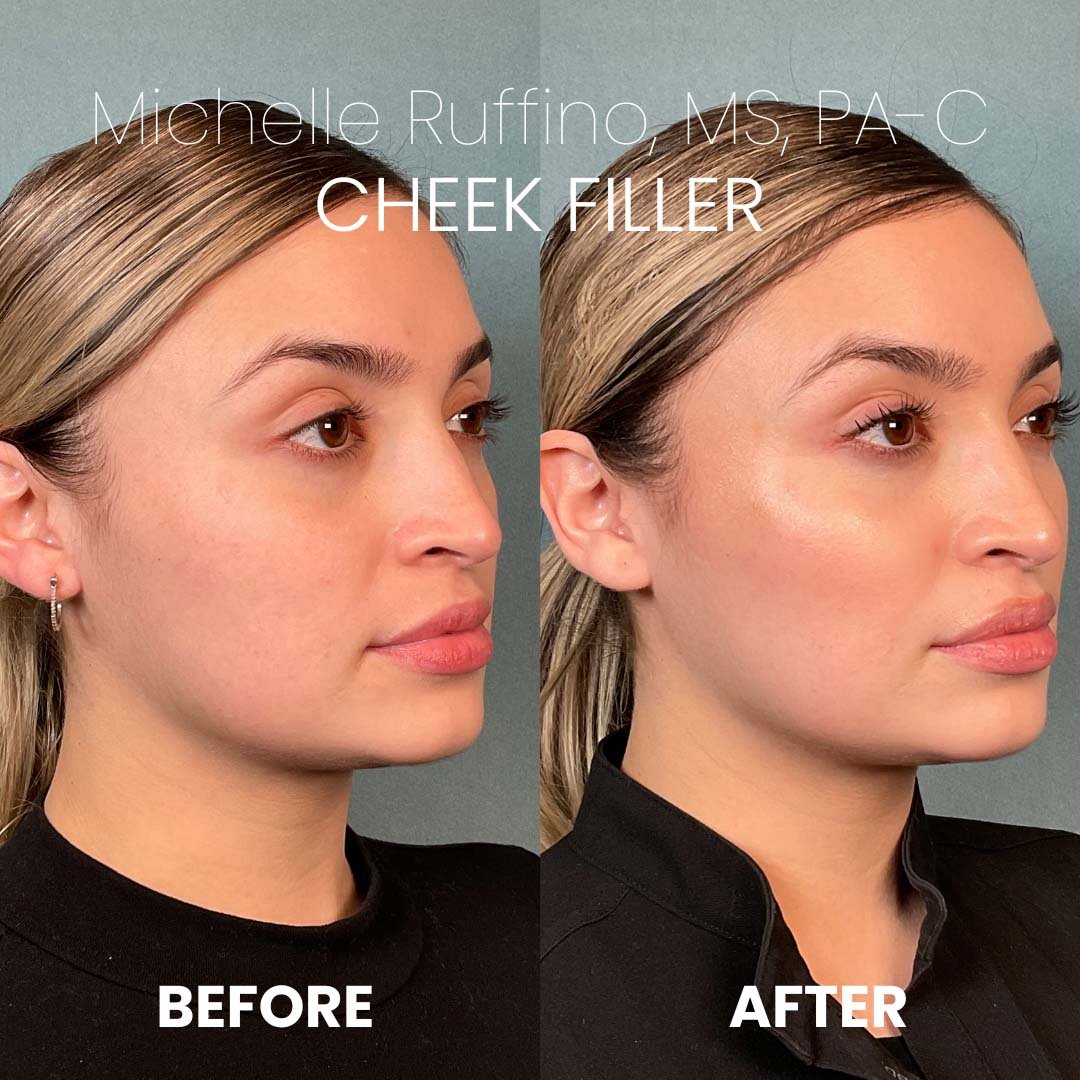 Dermal Fillers in Chicago | Impressions Face + Body