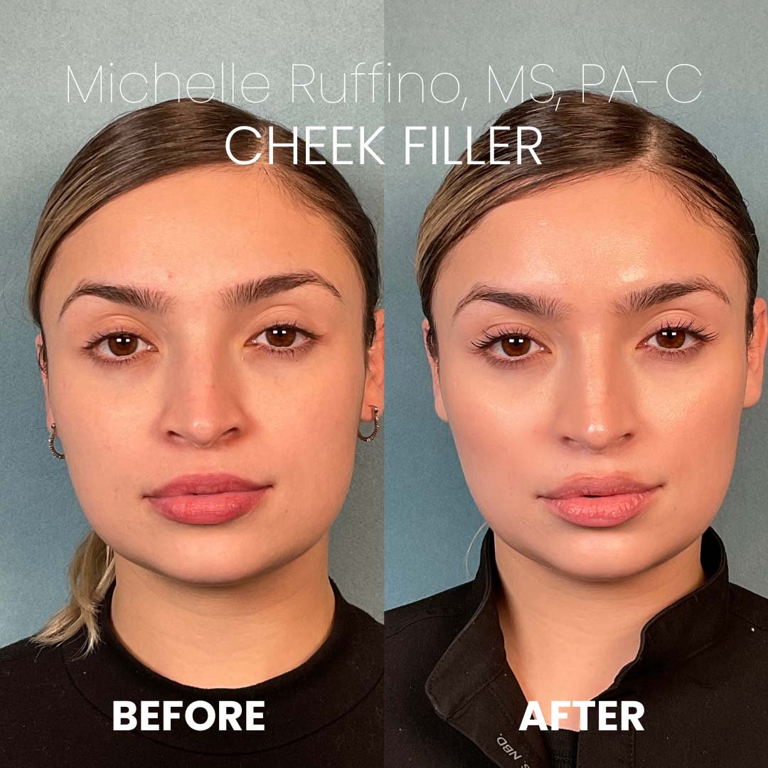 Dermal Fillers in Chicago | Impressions Face + Body