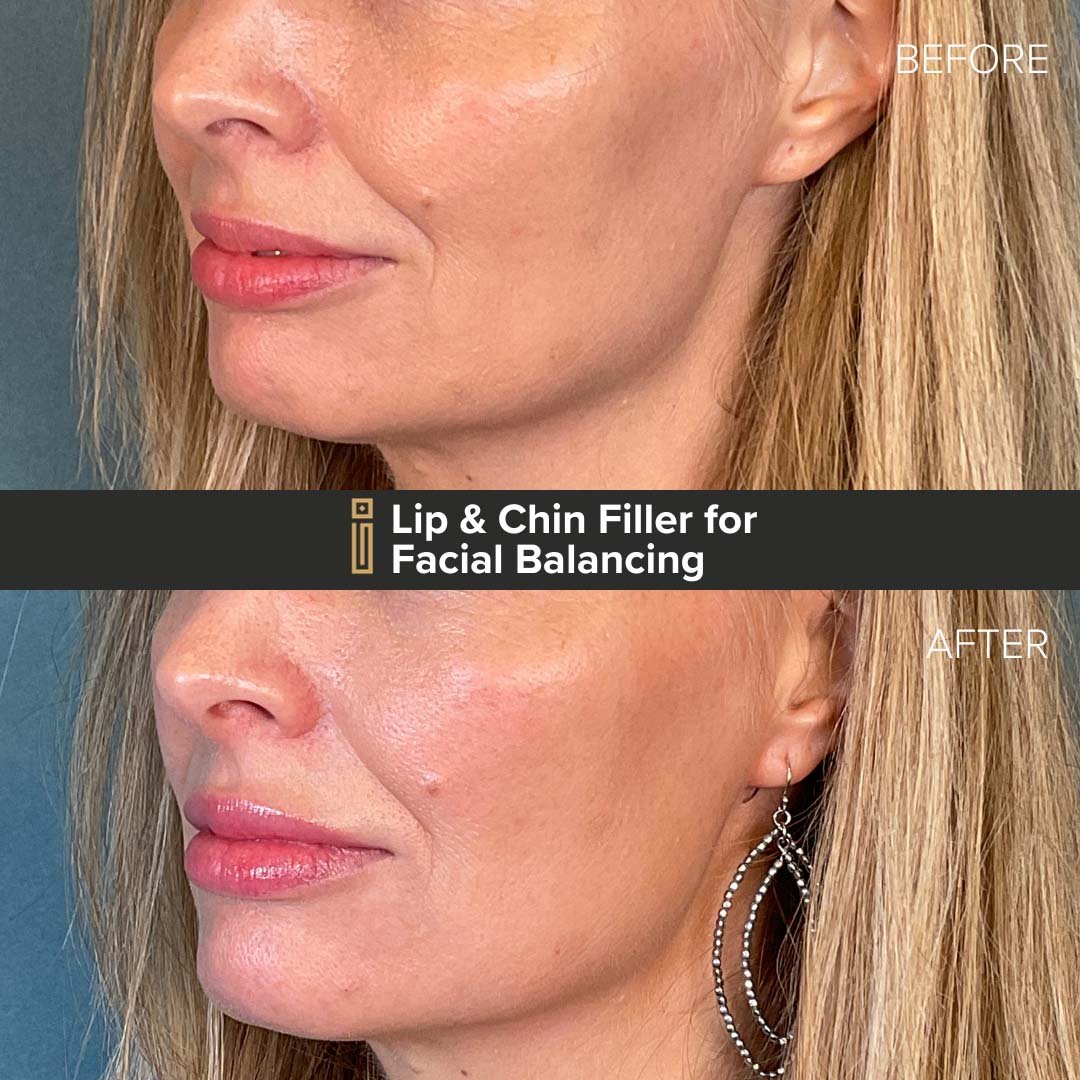 Dermal Fillers in Chicago | Impressions Face + Body
