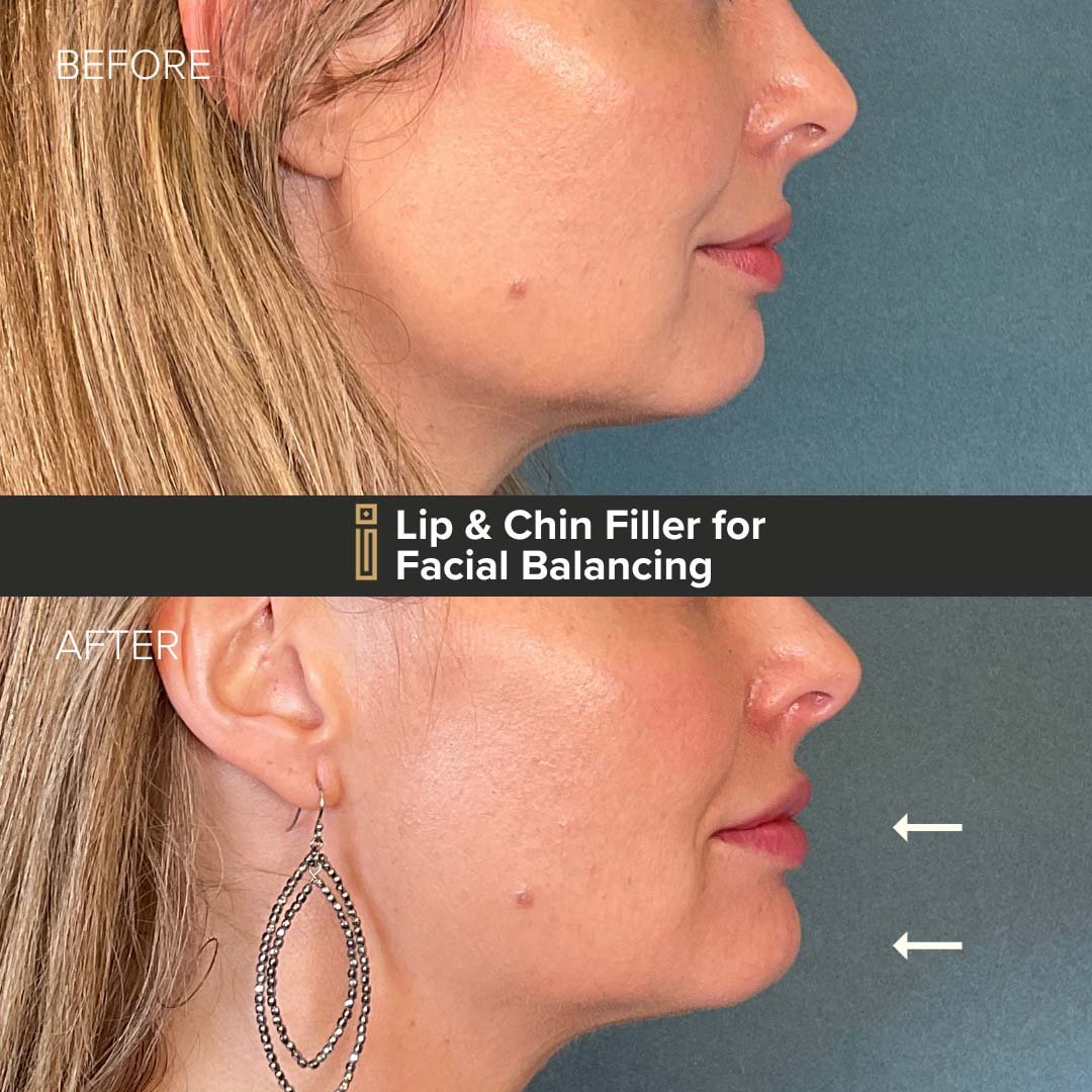 Dermal Fillers in Chicago | Impressions Face + Body