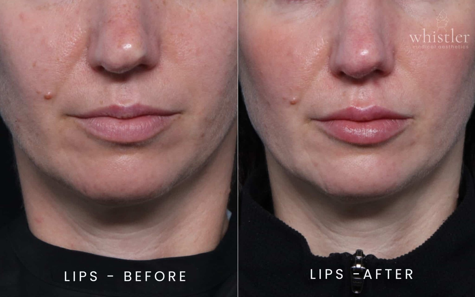 5 Major Lip Filler Benefits