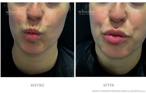MD Codes™: The Only Approach To Facial Aesthetic Injectables - Whistler ...
