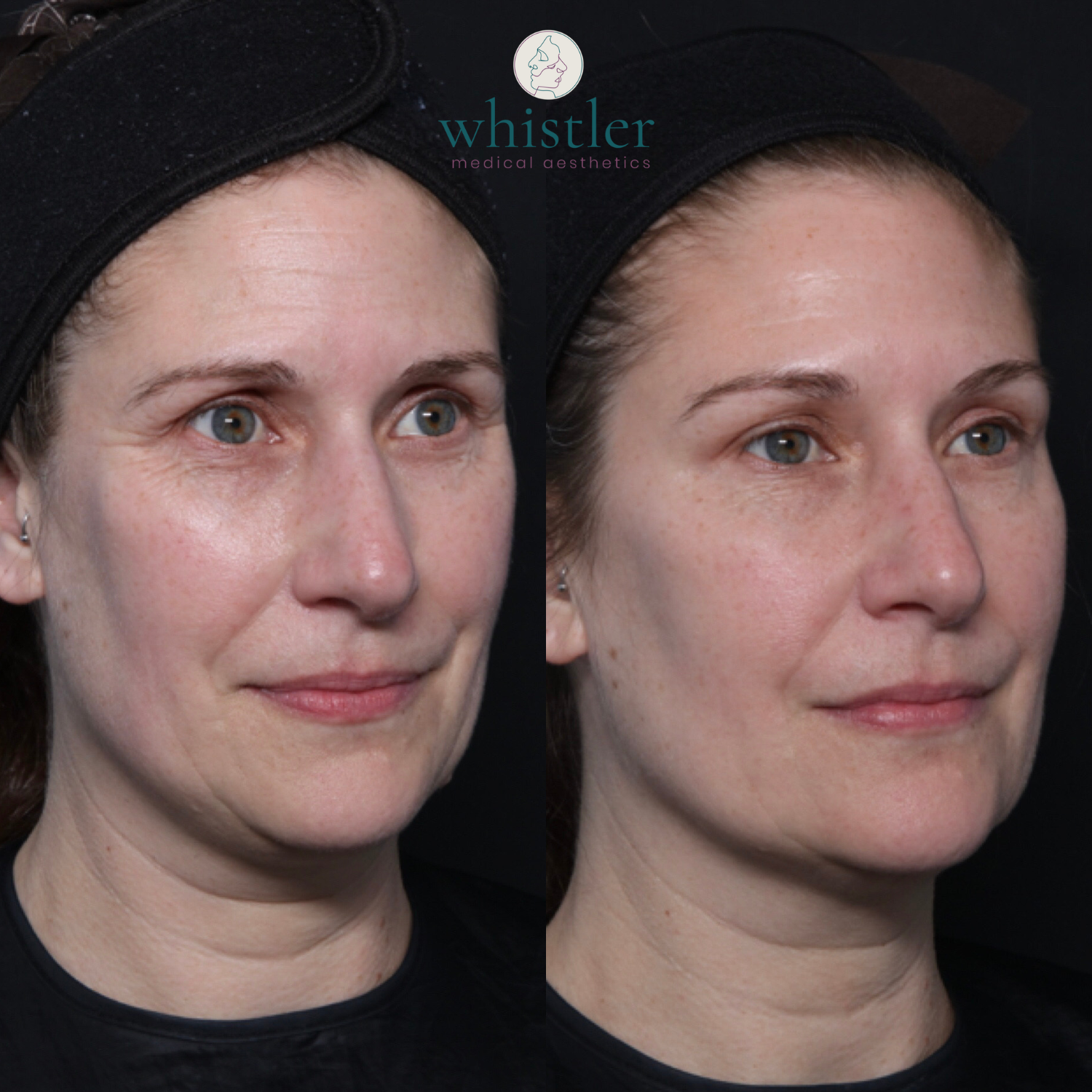 Whistler Medical Aesthetics Injectable Treatments