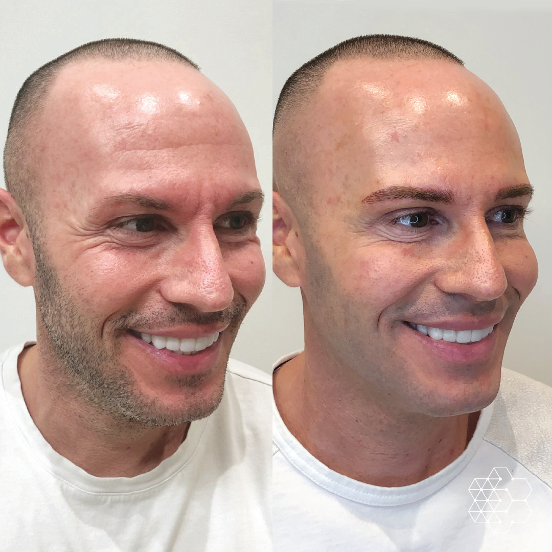 Skin Technique Injectable Treatments