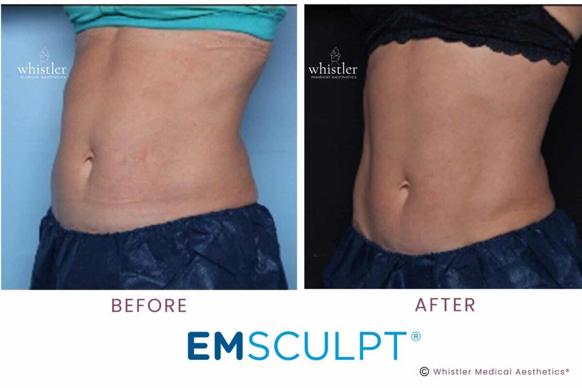 Breakthrough Treatment For Diastasis Recti - Whistler Medical Aesthetics